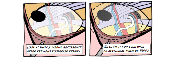 Liesbreukchirurgie; Lichtenstein in een ander perspectief